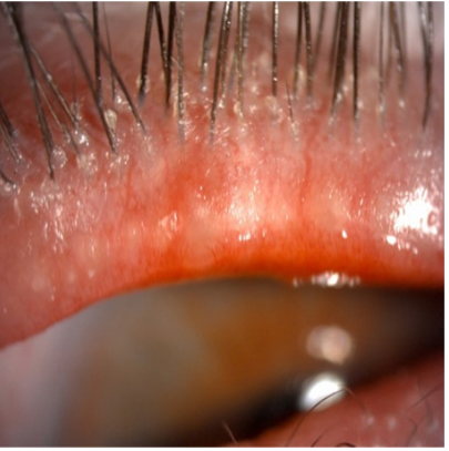 Treatment of mild forms of blepharitis using direct plasma discharge ...