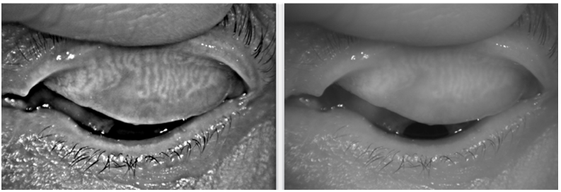 Treatment of mild forms of blepharitis using direct plasma discharge ...