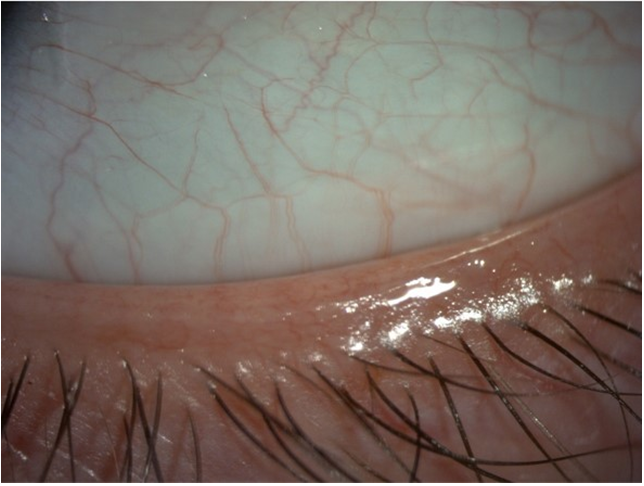 Treatment of mild forms of blepharitis using direct plasma discharge ...