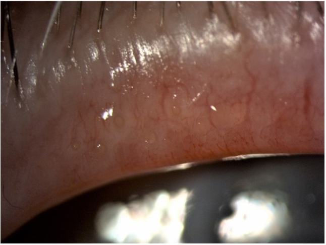 Treatment of mild forms of blepharitis using direct plasma discharge ...