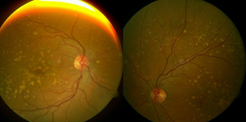 An atypically distributed fleck case with multiple retinal pigment ...