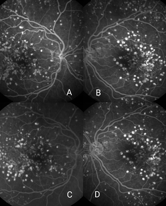 An atypically distributed fleck case with multiple retinal pigment ...