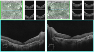 Diagnosis and management of serpiginous choroiditis - MedCrave online