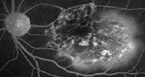 Diagnosis and management of serpiginous choroiditis - MedCrave online