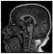 Regression of non-functioning pituitary macroadenoma on cabegoline ...