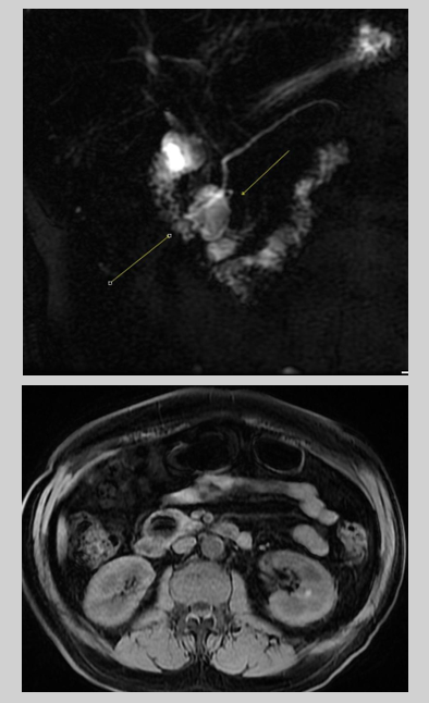 Surgical resection of duodenal diverticulum due to Lemmel’s syndrome: a ...