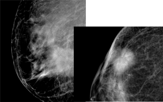 Intrinsic subtypes of breast cancer in malignant speculating mass on ...