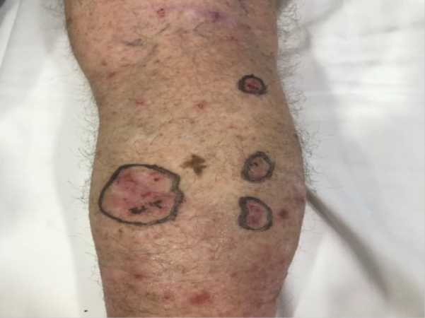 Techniques to verify the correct skin areas for biopsy, treatment ...