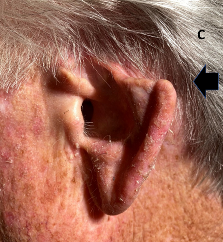 Lesion-based radiotherapy of the ears, lips and eyelids for skin cancer ...
