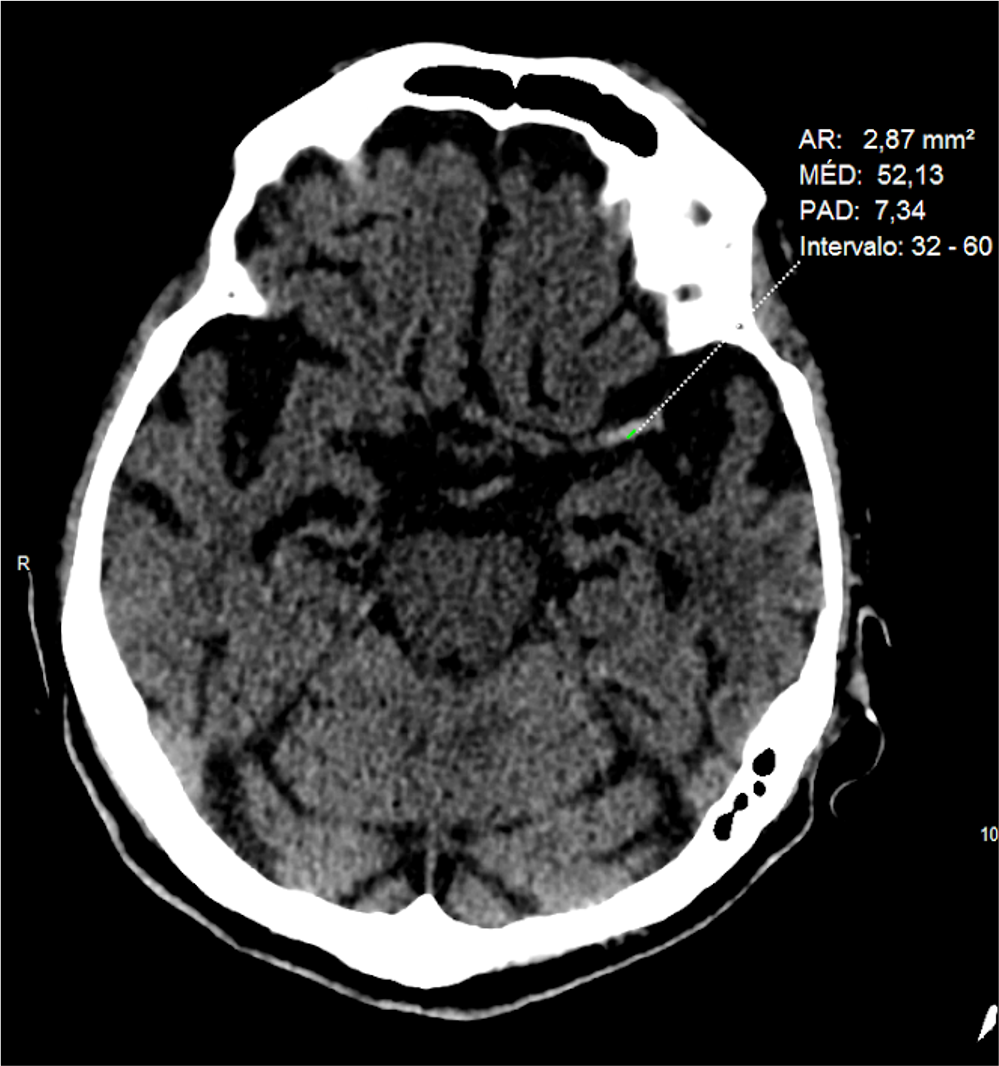 Radiological CT findings and time evolution in acute stroke: case ...