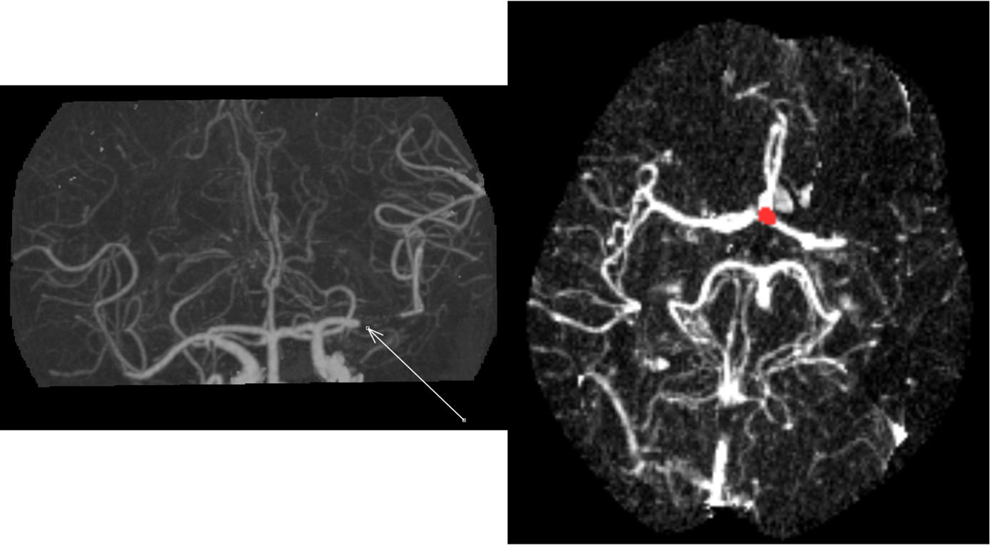 Radiological CT findings and time evolution in acute stroke: case ...
