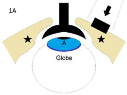 A technique for external beam radiotherapy to the eyelid without the ...
