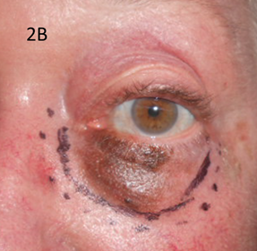 A technique for external beam radiotherapy to the eyelid without the ...