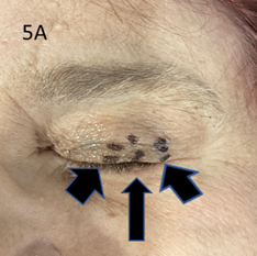 A technique for external beam radiotherapy to the eyelid without the ...