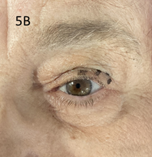 A technique for external beam radiotherapy to the eyelid without the ...