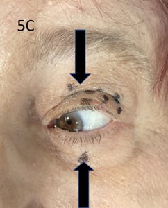 A technique for external beam radiotherapy to the eyelid without the ...