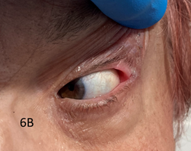 A technique for external beam radiotherapy to the eyelid without the ...