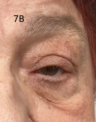 A technique for external beam radiotherapy to the eyelid without the ...