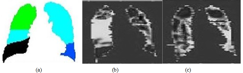 Early diagnosis of pulmonary embolism using deep learning and SPECT/CT ...