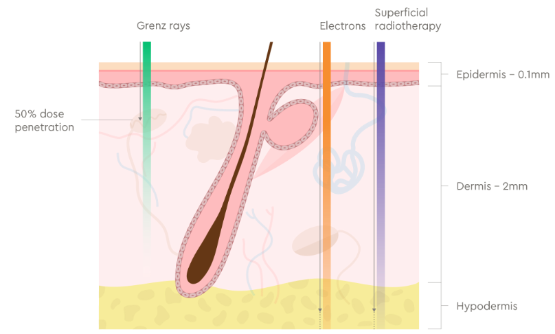 Systematic review of radiotherapy for cutaneous psoriasis: bringing an ...