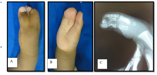 Use of reverse second dorsal metacarpal artery flap for the treatment ...