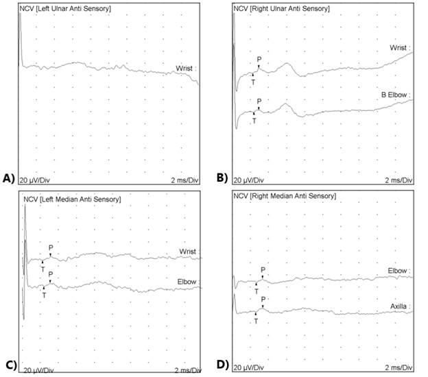 Thalidomide-induced sensory axonal polyneuropathy: A case report ...