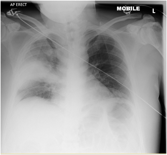 Panton-valentine leukocidin staphylococcus causing necrotising ...