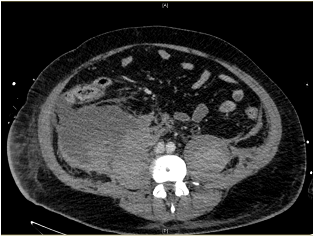 Panton-valentine leukocidin staphylococcus causing necrotising ...