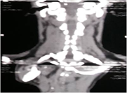 Primary tracheal resection - the last resort to manage a difficult ...