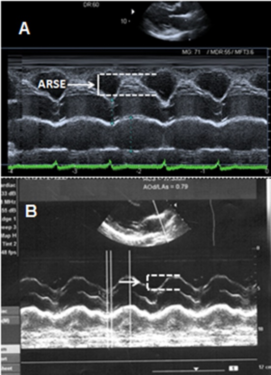 Aortic root systolic excursion and its association with exercise ...