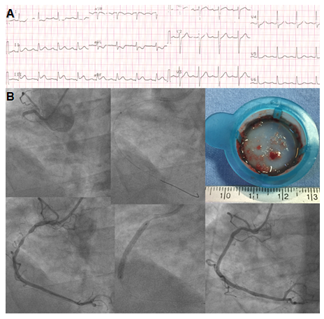 Temporary and reversible clopidogrel, ticagrelor and prasugrel high on-treatment platelet ...