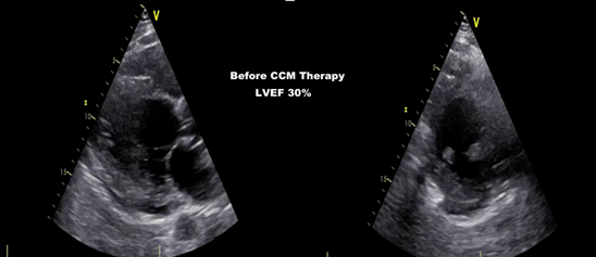 Rejuvenating a failing heart: A case report - MedCrave online