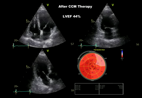 Rejuvenating a failing heart: A case report - MedCrave online