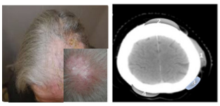 Holo-cranial brain sparing total scalp tomotherapy and neoprene cap in ...