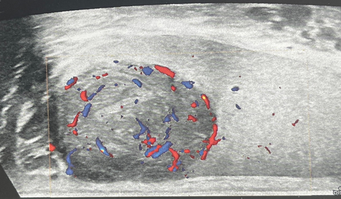 Case report of a very rare testicular tumor - MedCrave online