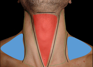 Lateral neck lymph node dissection in papillary thyroid cancer: tactics ...