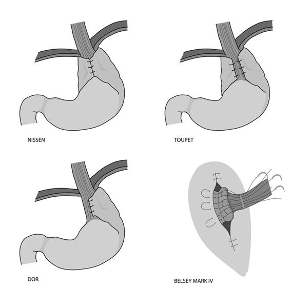 Gastroesophageal reflux disease and hiatal hernia protocol - MedCrave ...