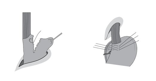 Gastroesophageal reflux disease and hiatal hernia protocol - MedCrave ...