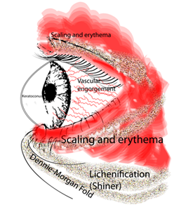 Ocular manifestations of atopic dermatitis - MedCrave online