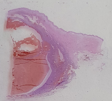 Giant aneurysmal dermatofibroma: a case of the rare variant of ...
