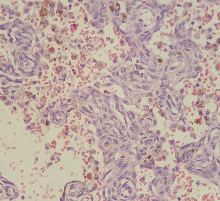 Giant aneurysmal dermatofibroma: a case of the rare variant of ...