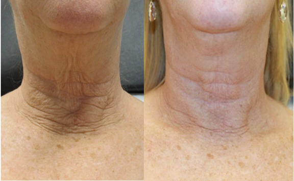 Microneedling with radiofrequency for improvement in neck skin laxity ...