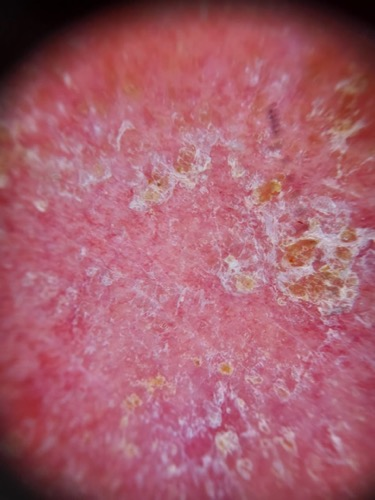 Grover’s disease: a rare bullous dermatosis spontaneously regressing ...