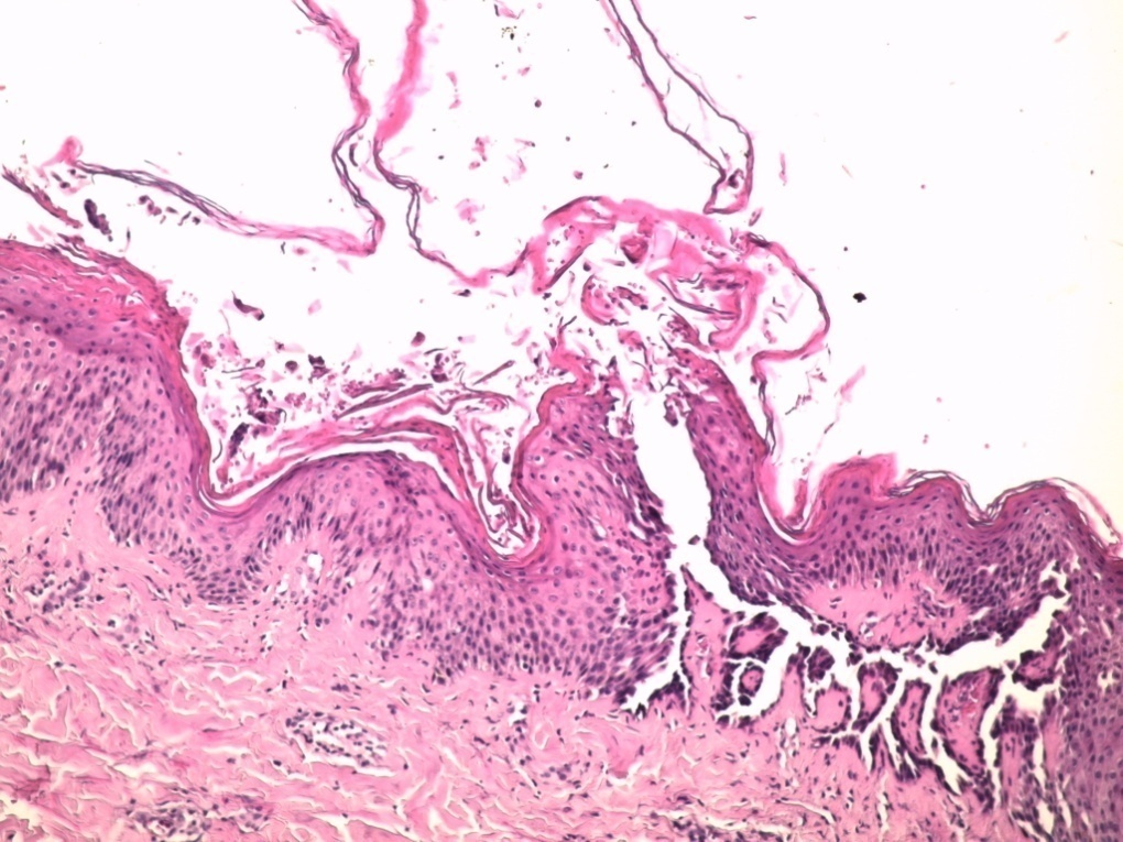 Grover’s disease: a rare bullous dermatosis spontaneously regressing ...