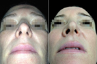 Nonsurgical rhinoplasty with hyaluronic acid to enhance precise areas ...