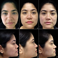Nonsurgical rhinoplasty with hyaluronic acid to enhance precise areas ...