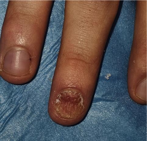 Nail lichen planus of a single fingernail successfully treated with ...