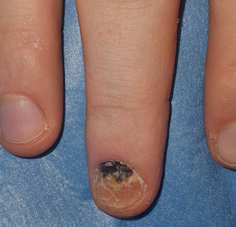 Nail lichen planus of a single fingernail successfully treated with ...