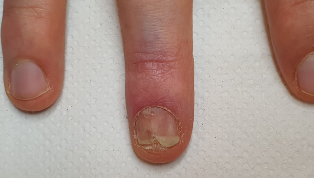 Nail lichen planus of a single fingernail successfully treated with ...