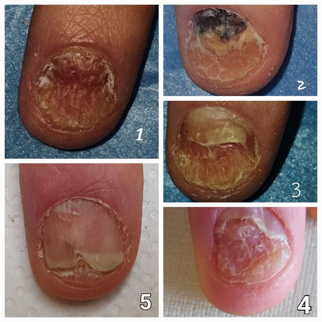 Nail lichen planus of a single fingernail successfully treated with ...